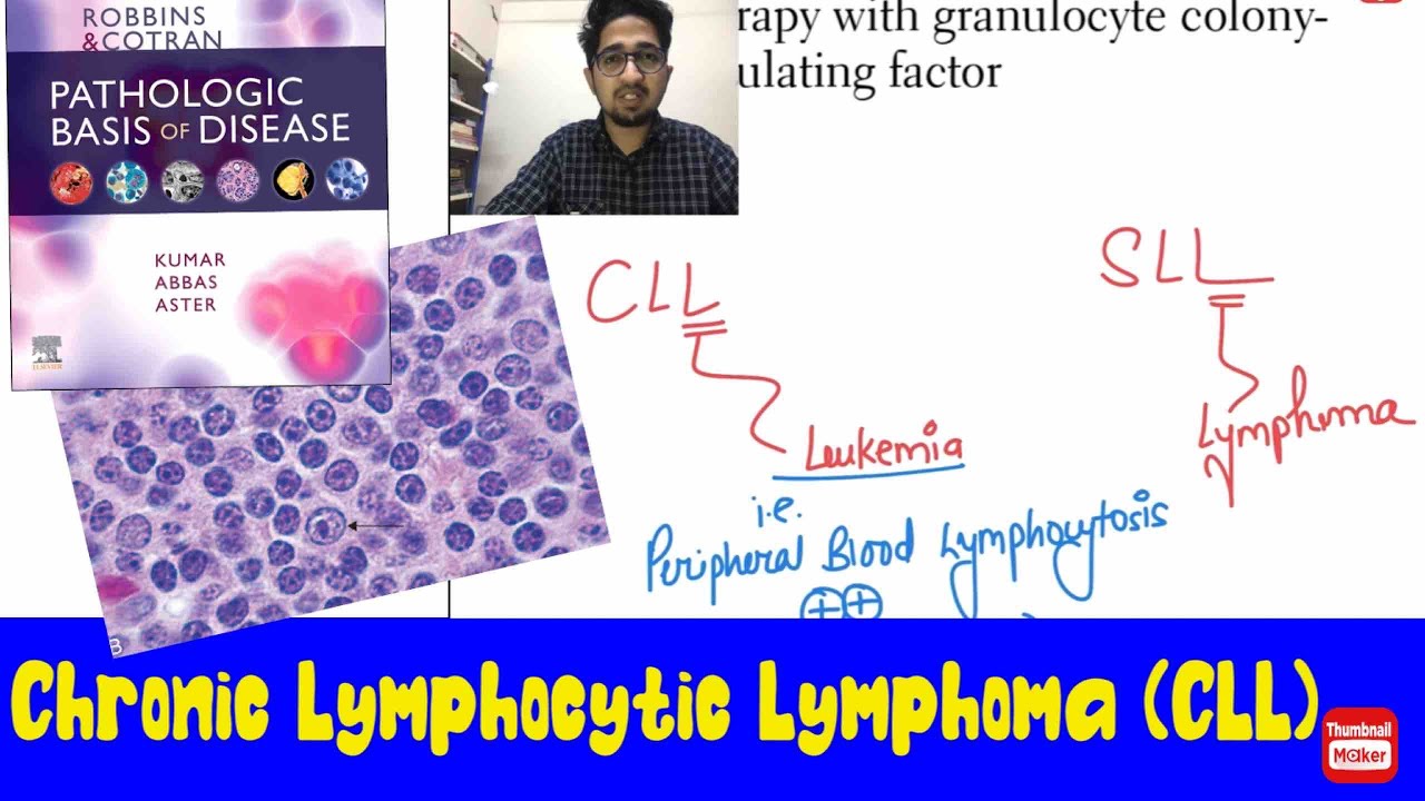 Chronic Lymphocytic Leukemia(CLL) /Small Lymphocytic Lymphoma (SLL) # ...