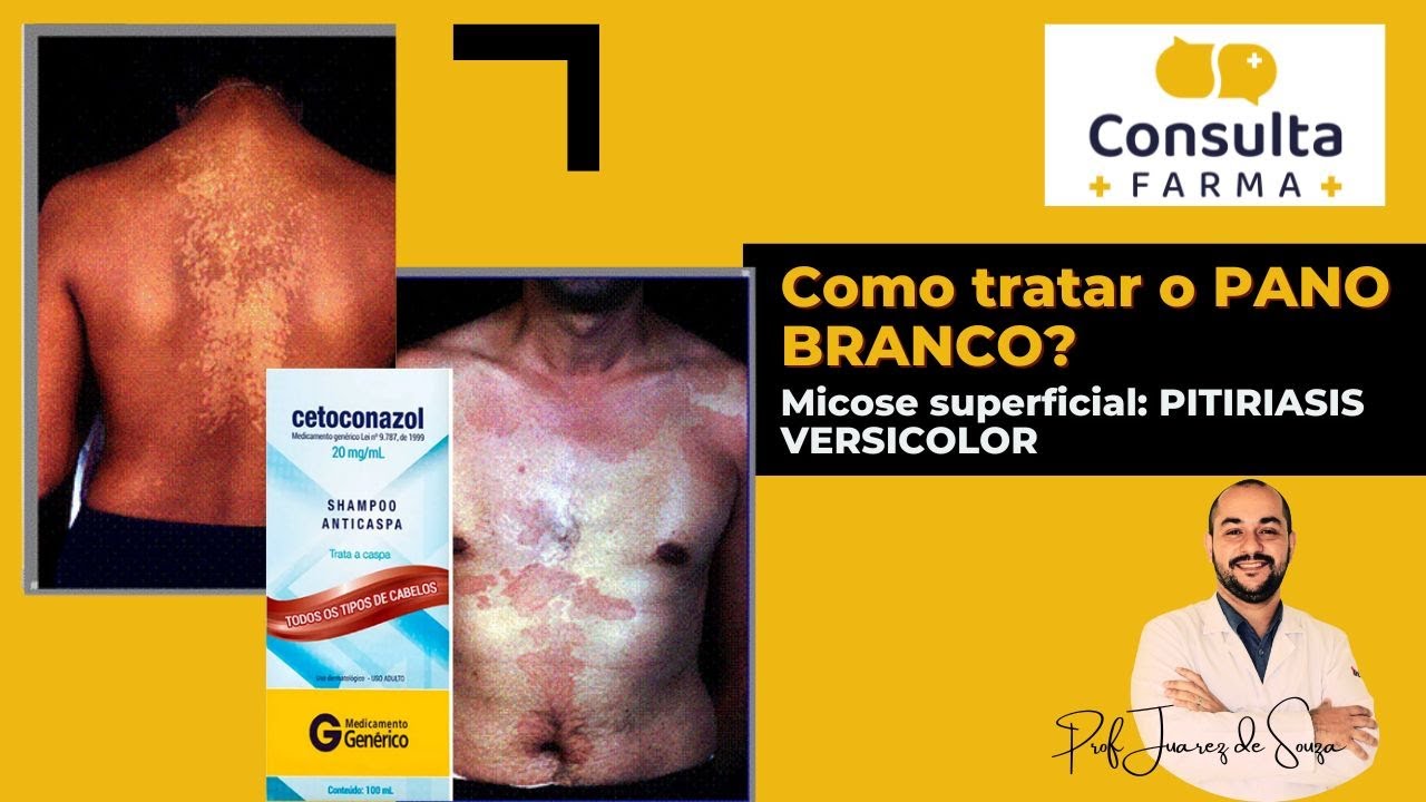 Pano Branco | Como realizar o tratamento? - YouTube