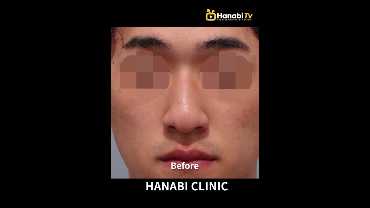 [Hanabi TV] Male rhinoplasty before and after #rhinoplasty #hump_removal - YouTube