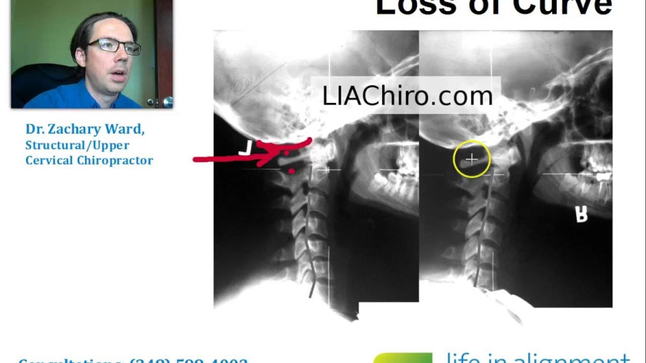 Can chiropractors change neck curve? Alignment matters - YouTube