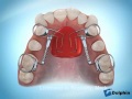 dolphin ortho - YouTube