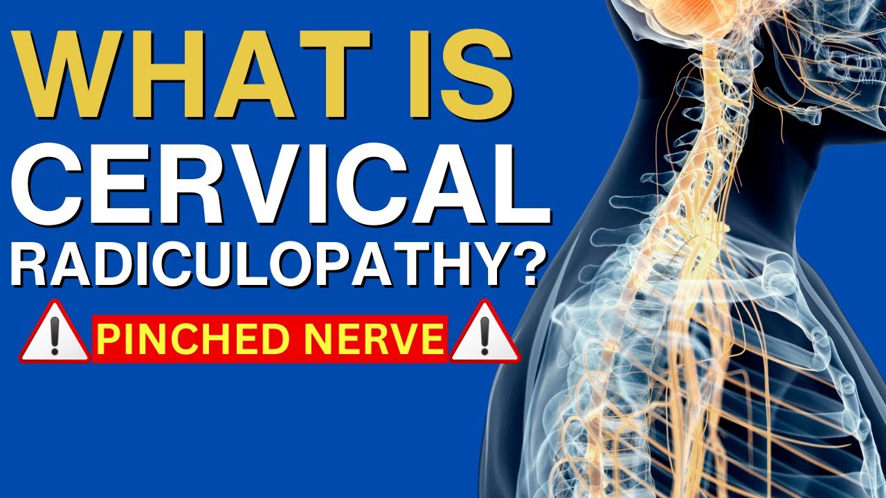 Understanding Cervical Radiculopathy, Nerve Compression, Neck Pain ...