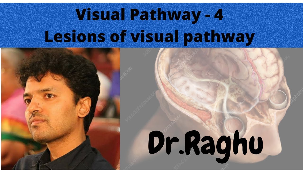 Visual Pathway -4 (Lesions of Visual Pathway) - YouTube