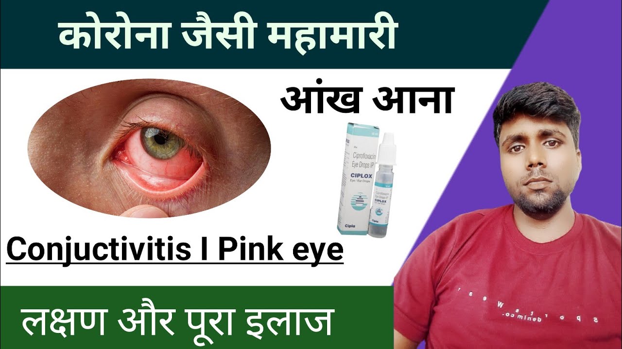 CONJUCTIVITIS: आंख आना I PINK EYE I SYMPTOM I MEDICINE I TREATMENT ...