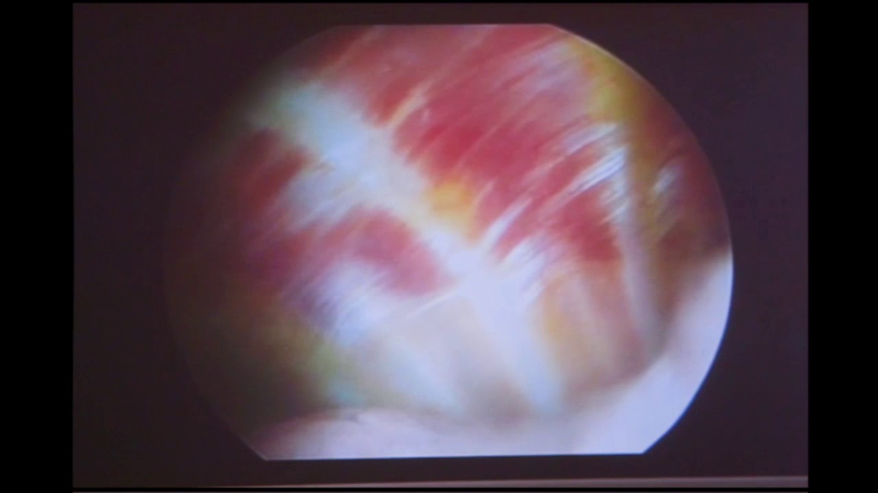 Live in a Box 1 : Robotic Right Lower lobectomy with a subxiphoid ...