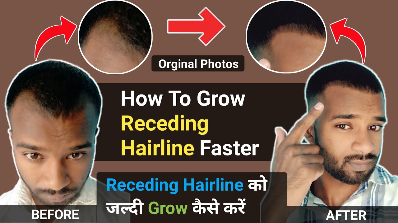 How To Grow Receding Hairline Fast || Grow Receding Hairline Faster ...