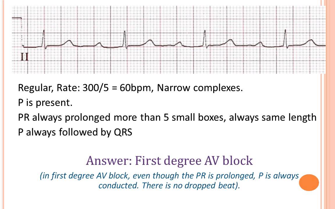 Basic ECG Rhythm Interpretation by Junainah Nor Part 2 - YouTube