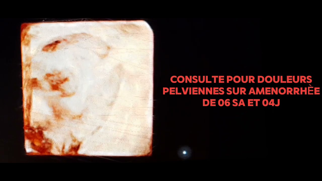 GEU interstitielle.. écho 3D - YouTube
