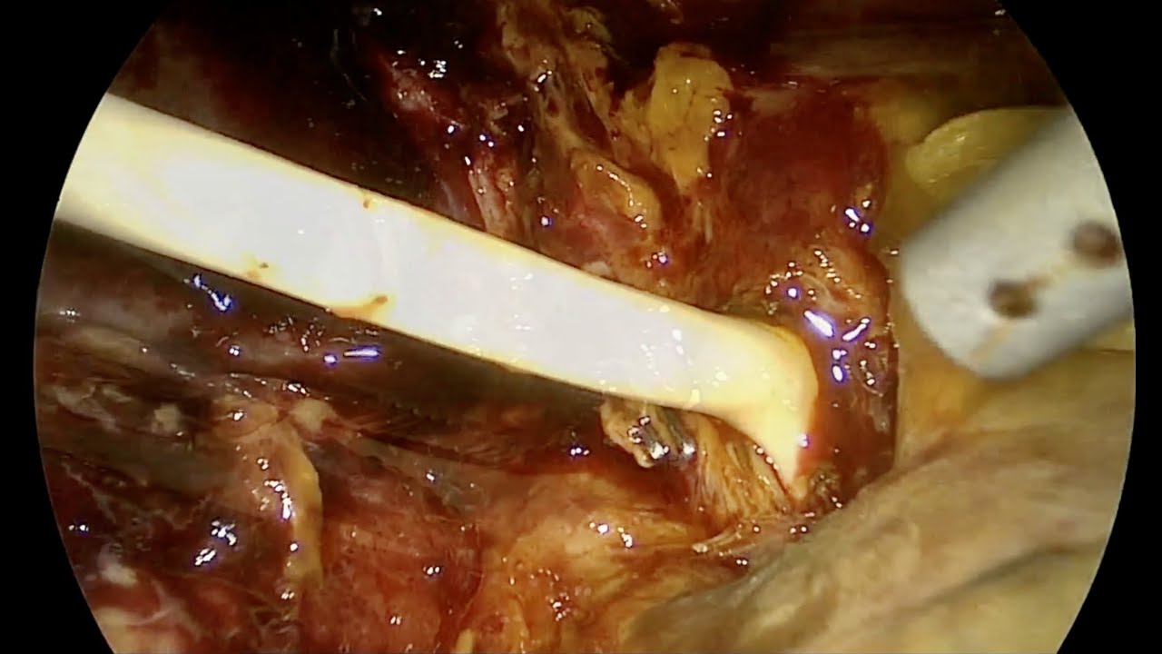 Laparoscopic management of post-cholecystectomy bile leak - YouTube