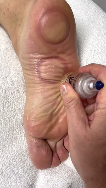 Myofasical Sliding Cupping For Plantar Fasciitis Youtube