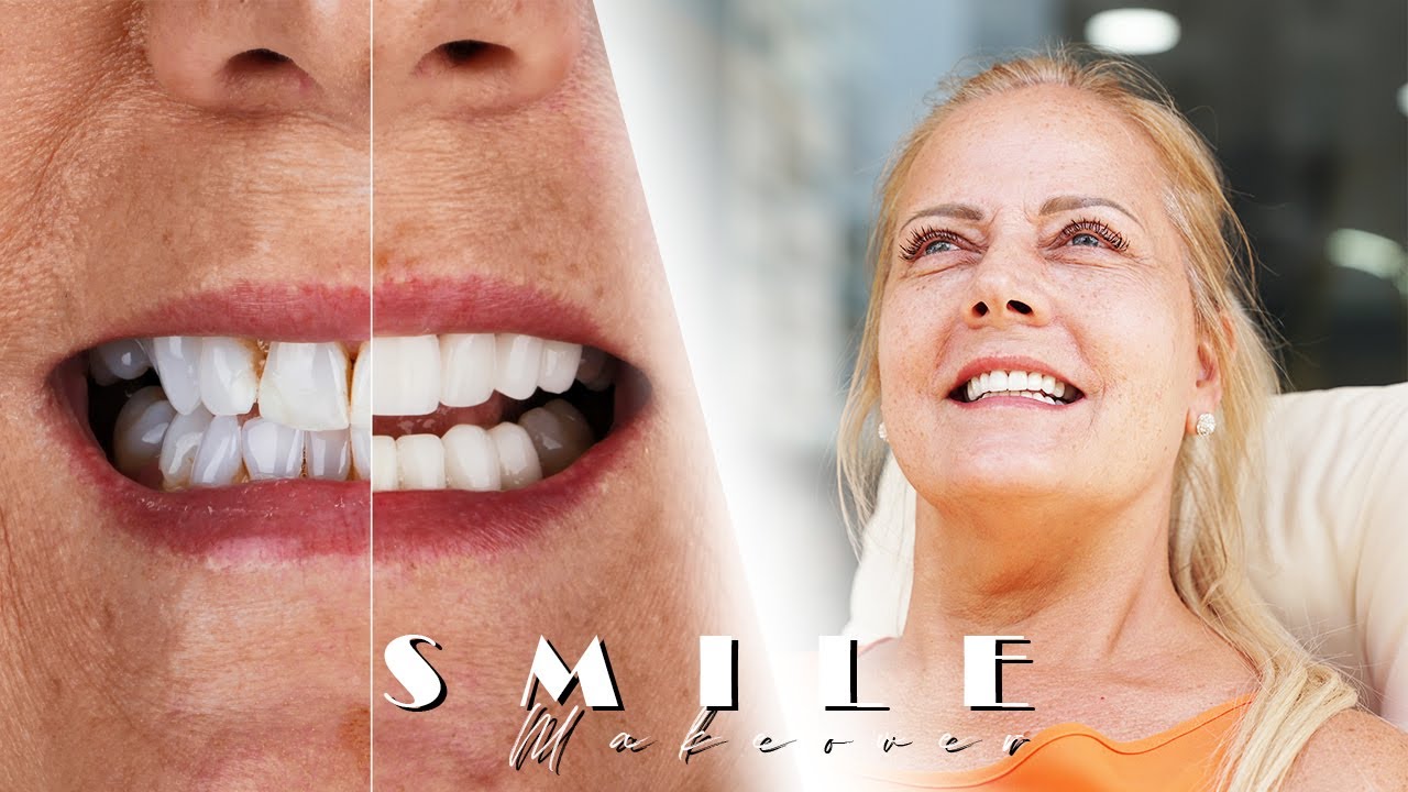 Smile Makeover / Testimonial / Dental Wise Turkey - YouTube