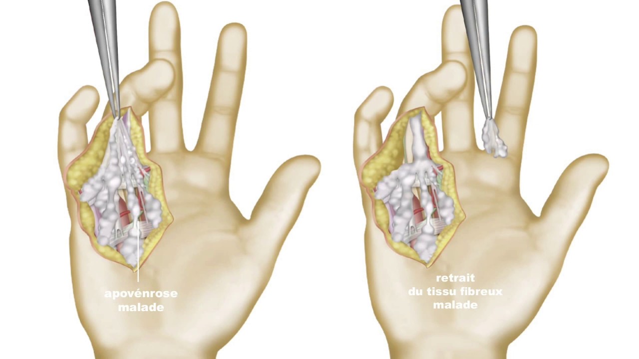 Maladie de Dupuytren : guérison et traitement naturel ou chirurgical ...