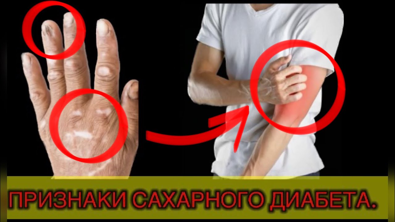 ПРИЗНАКИ САХАРНОГО ДИАБЕТА 30 людей НЕ ПОДОЗРЕВАЮТ Что у них ДИАБЕТ