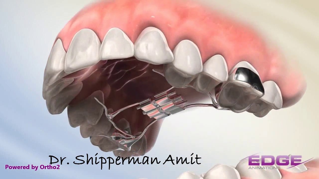 מכשיר הרחבה עם 2 טבעות Orthodontic expansion device - Hyrax - YouTube