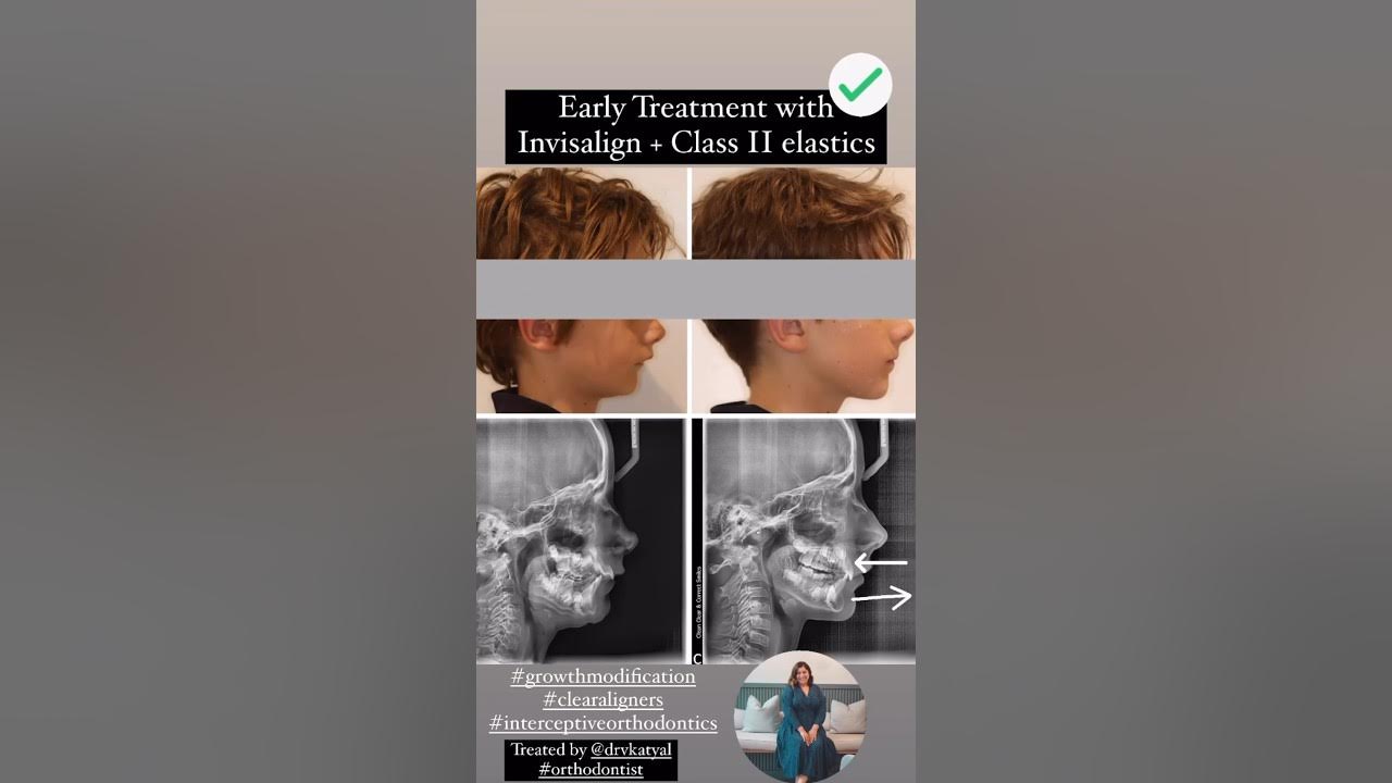 Mixed dentition Class 2 and overjet correction with invisalign using elastics #orthodontics # ...