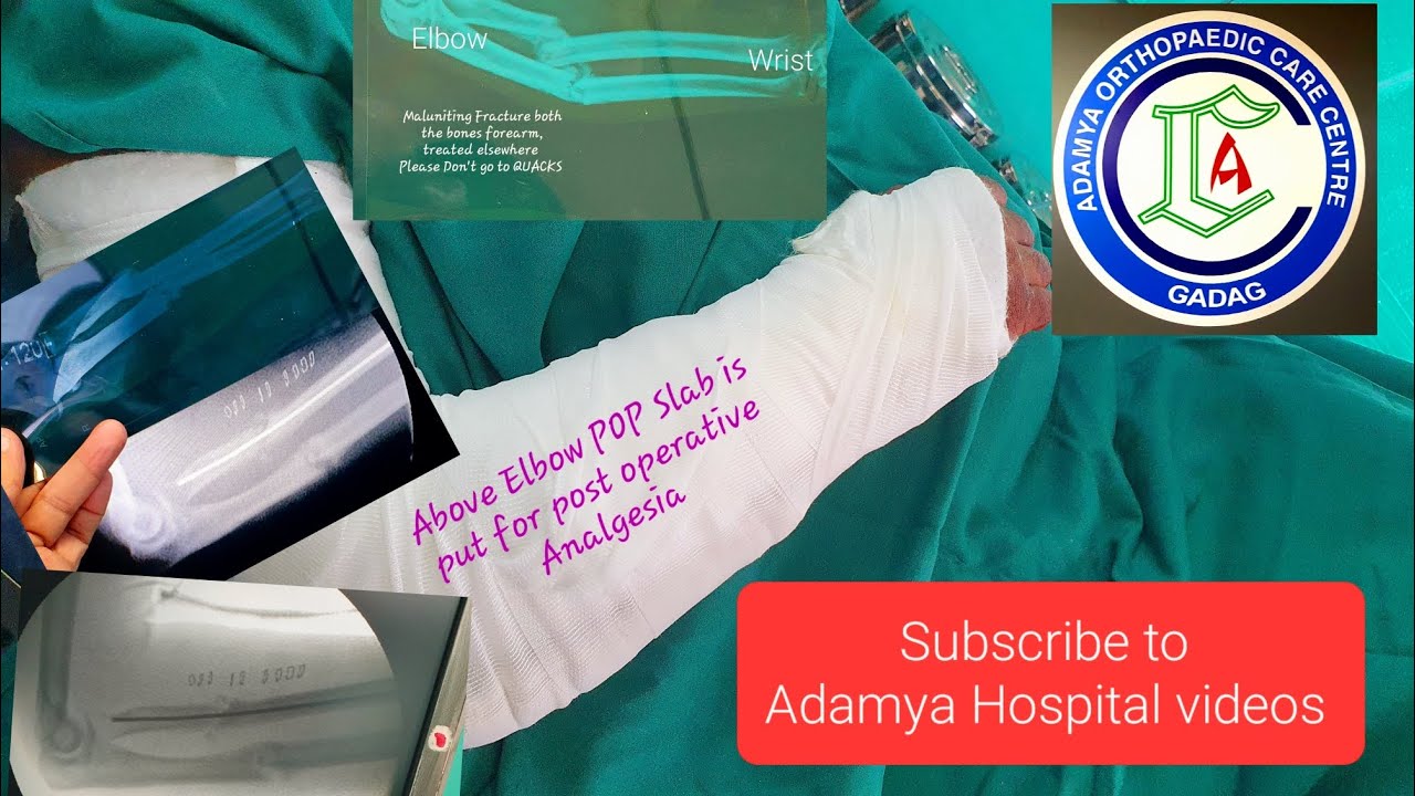 Maluniting fracture both bones forearm | Radial overriding | ORIF ...