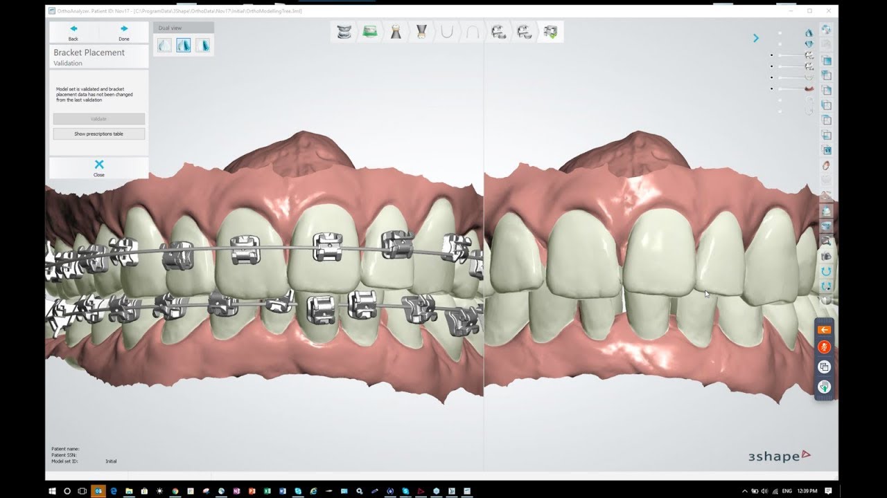 How To Use 3Shape Indirect Bonding Software with the BioQuick Bracket ...