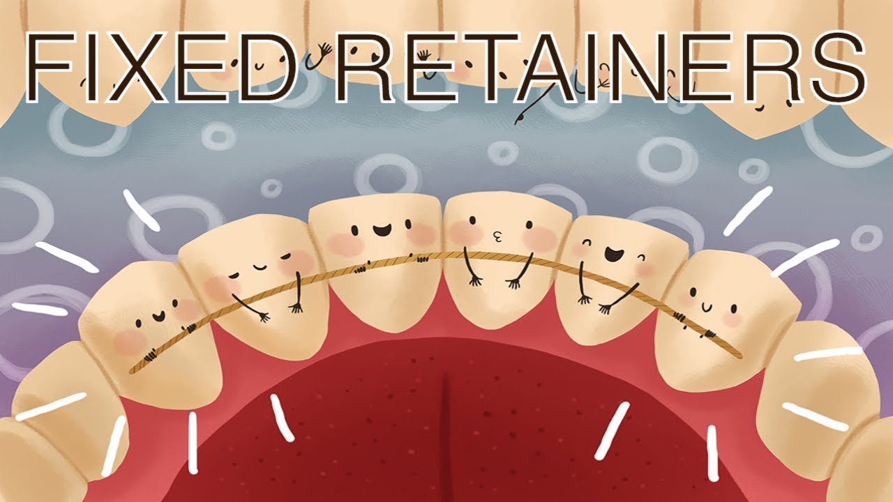 All About Fixed Retainers - YouTube