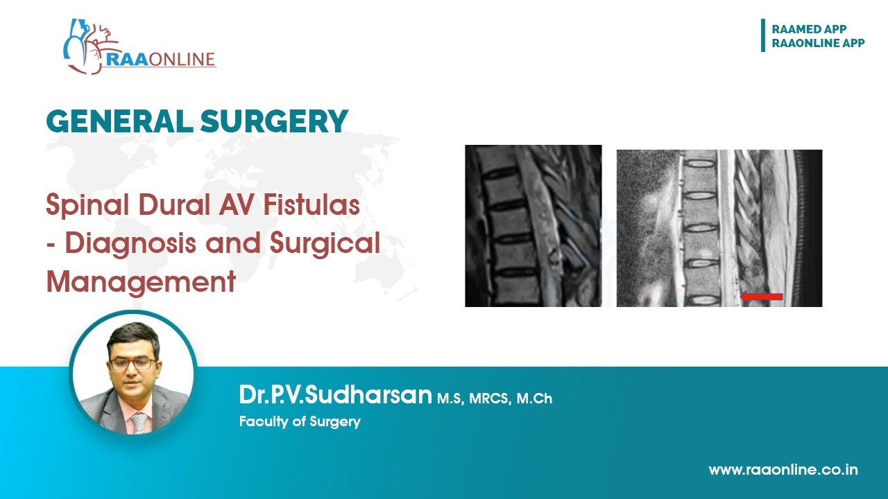 Spinal Dural AV Fistulas - Diagnosis and Surgical Management - YouTube