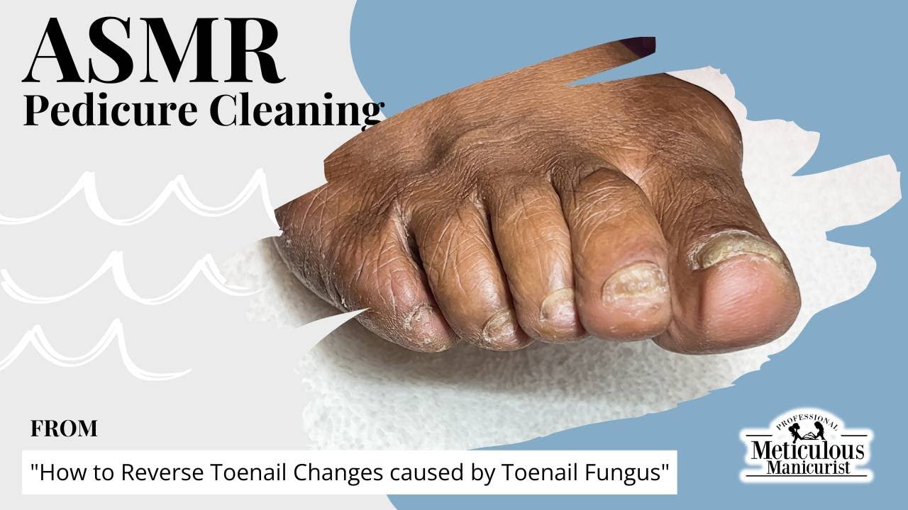 👣ASMR Pedicure Cleaning💆‍♀️How to Reverse Toenail Changes caused by ...