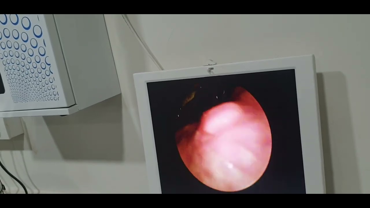 Foreign Body/Denture/Hypopharynx/Airway/Upper End trachea/Impacted ...