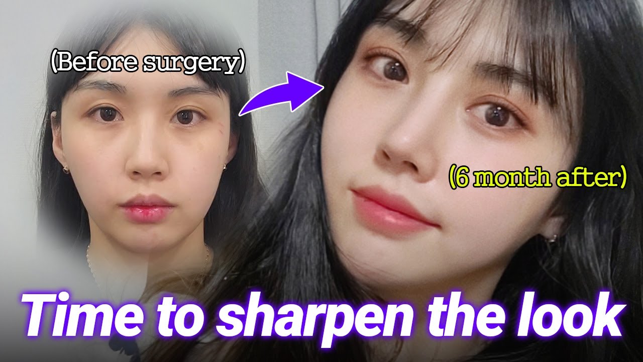 How can I have natural surgery result? - YouTube