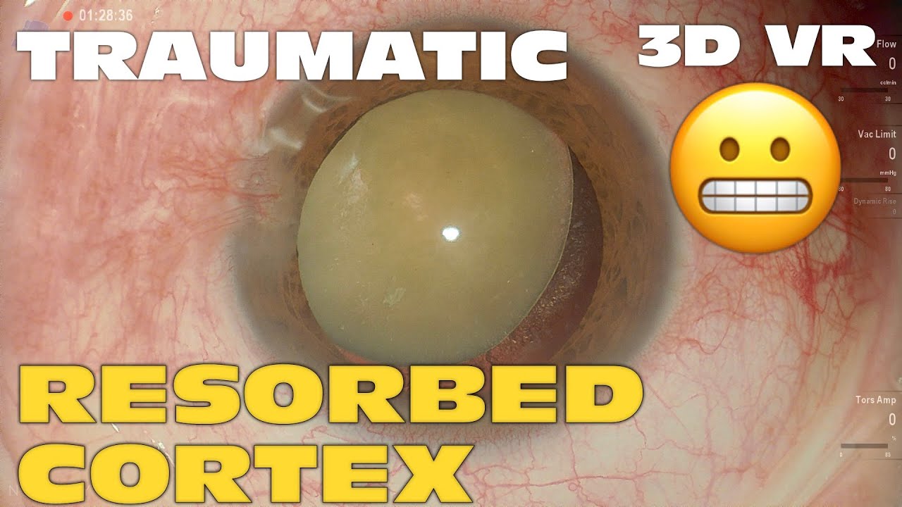 3D Phaco Clip #182 - Traumatic Cataract With Resorbed Cortex (VR ...