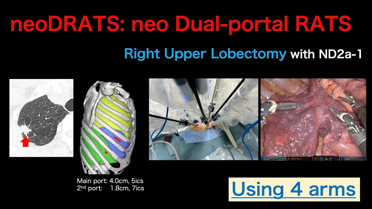 122】neoDRATS: neo-Dual-portal RATS Right Upper Lobectomy with ND2a-1 ...