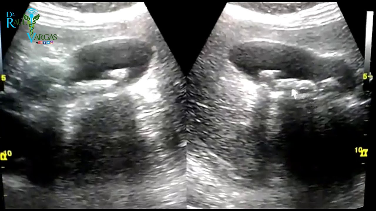 Dr Raúl Vargas: Litiasis Vesicular o Litiasis Biliar - YouTube