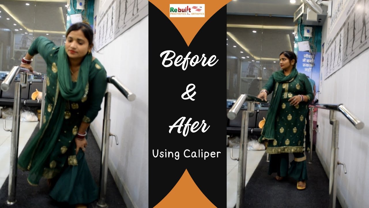 Use a Regular Knee Caliper Before and After and a Polio Caliper to Help ...