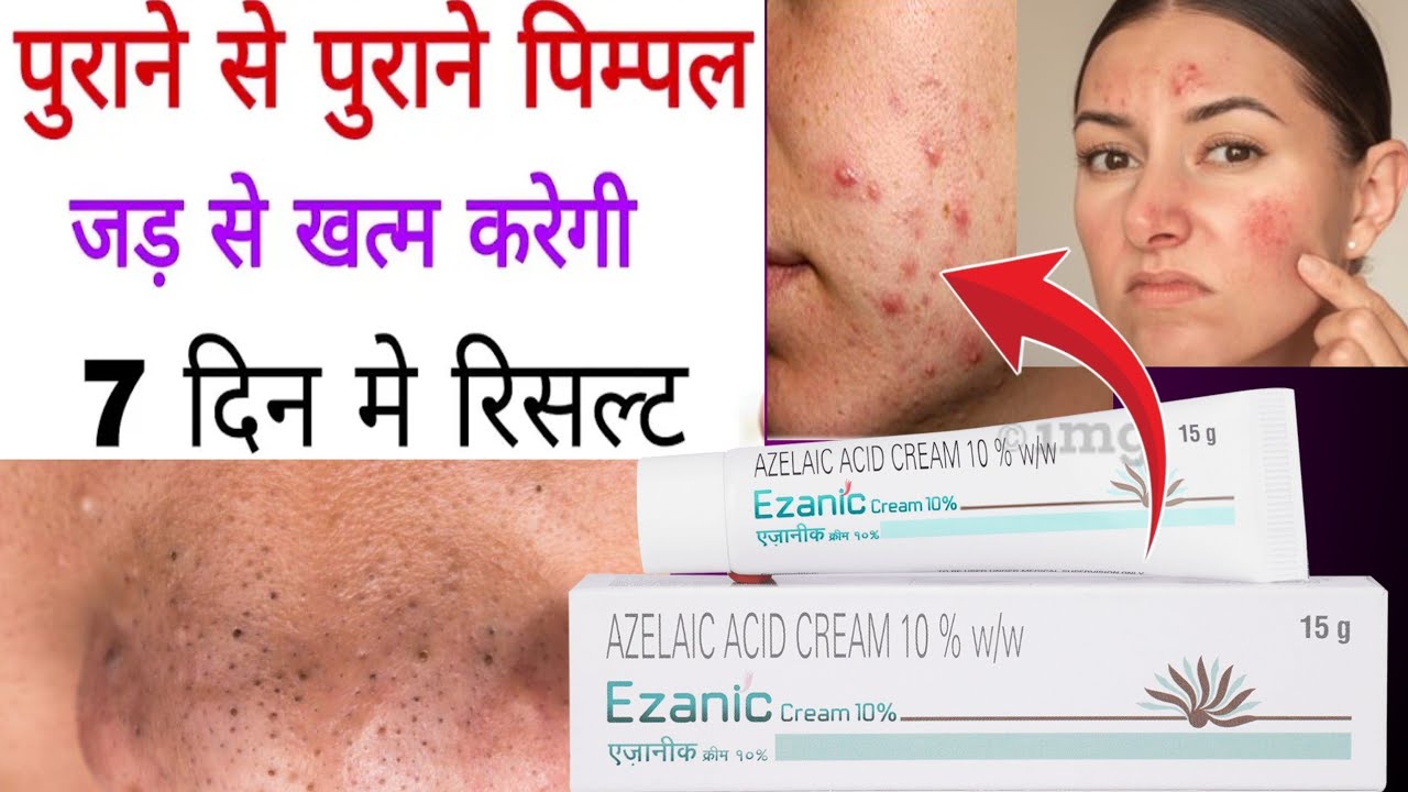Ezanic cream 20% | azelaic acid cream 20w/w | azelaic acid cream 20 w/w ...
