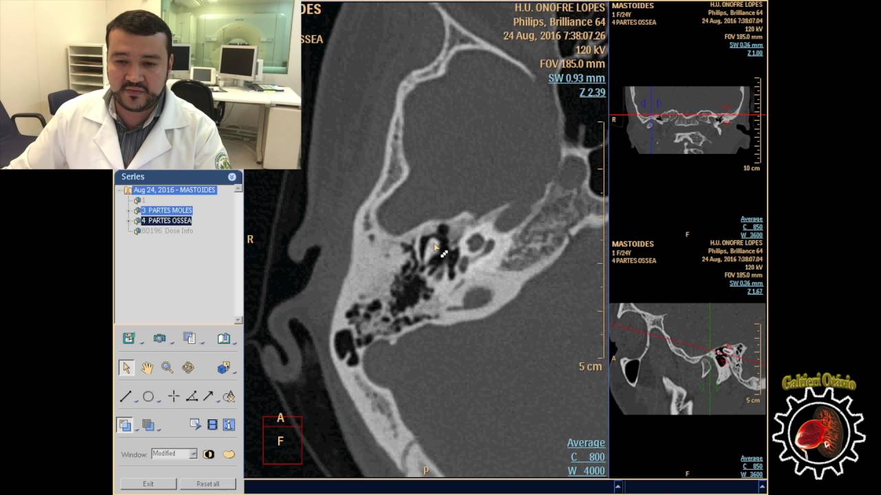TOMOGRAFIA DAS MASTOIDES - PASSO A PASSO DA DOMUMENTAÇÃO - YouTube