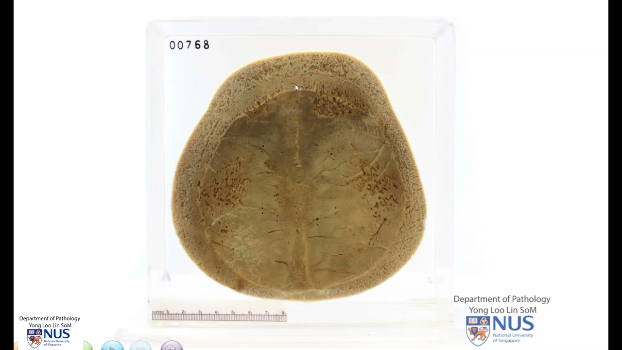 Skull: B Thalassemia major - YouTube