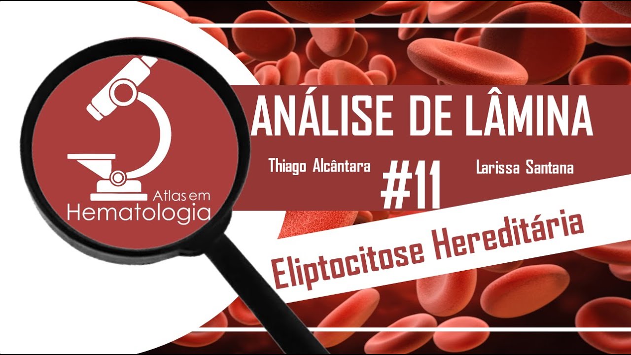 Eliptocitose Heritária-Análise de lâmina #11 - YouTube
