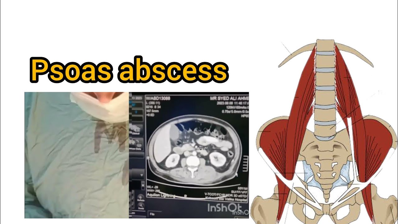 Psoas abscess ct scan / radiology | psoas abscess drainage treatment ...