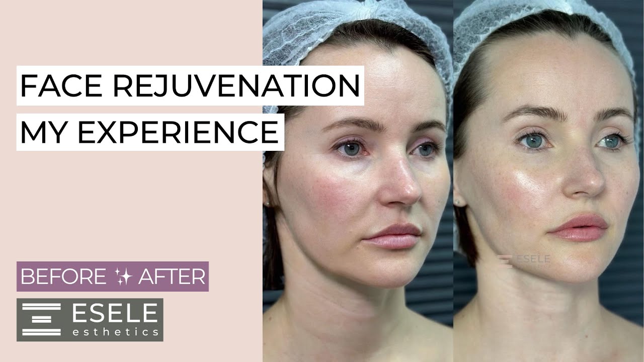 STOP! NO NEED TO USE BOTOX! THIS PROCEDURE SAVED MY FACE. What is ...