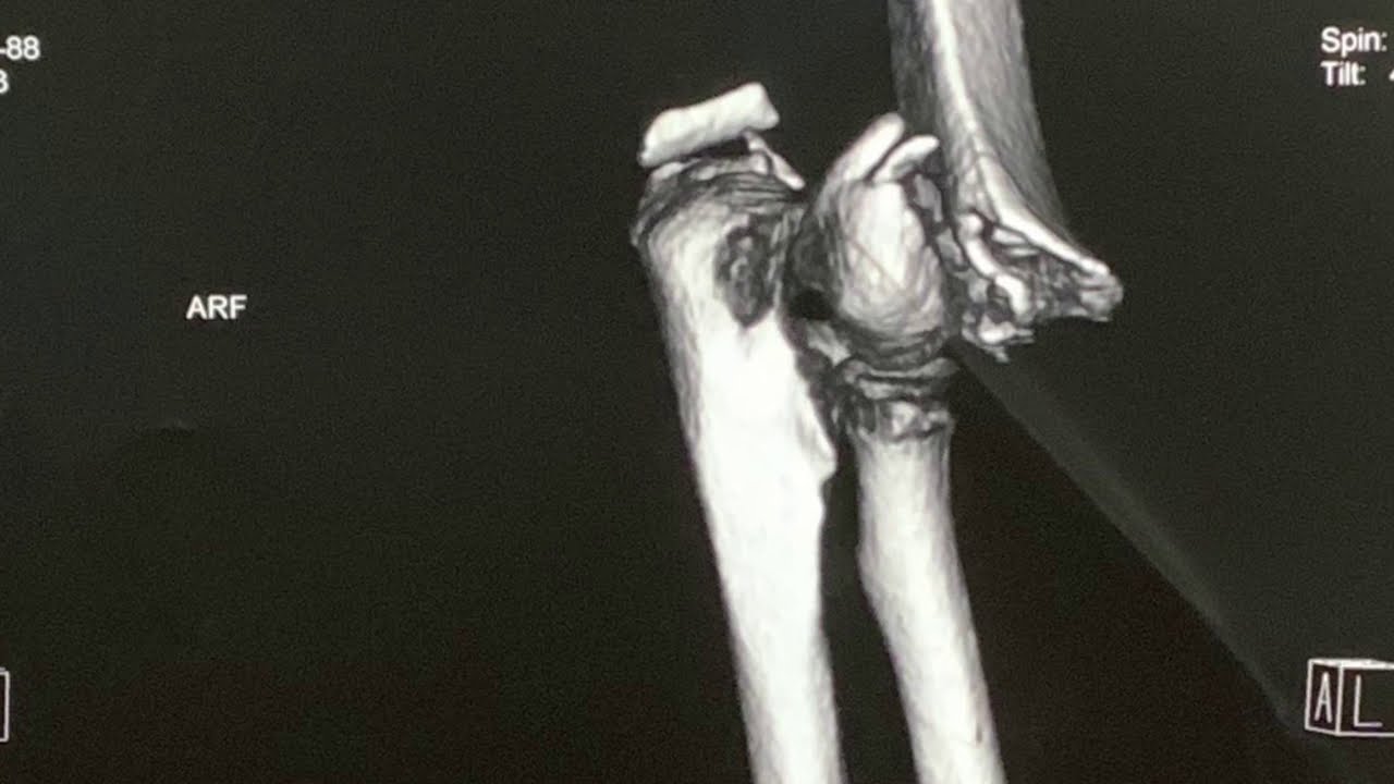 Simplified steps for Intercondylar (distal) humerus fracture fixation ...