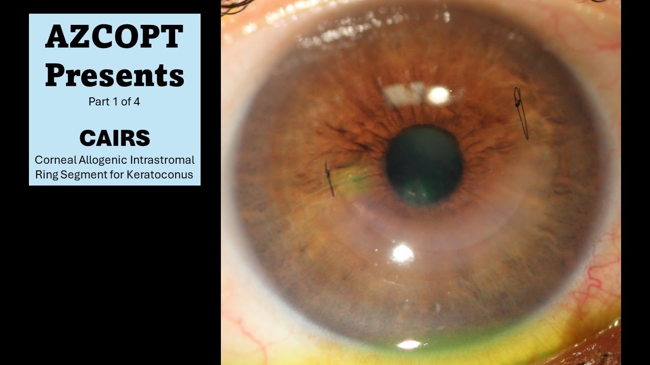 Treatment of Keratoconus: CAIRS Corneal Allogenic Intrastromal Ring ...