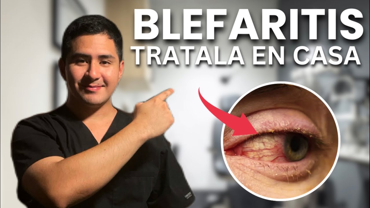 Tratamiento CASERO para la BLEFARITIS (3 PASOS) - YouTube