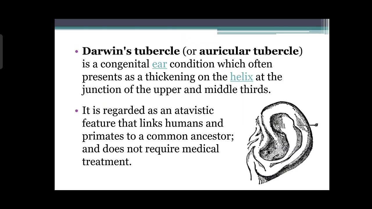 Darwin's Tubercle on pinna - YouTube