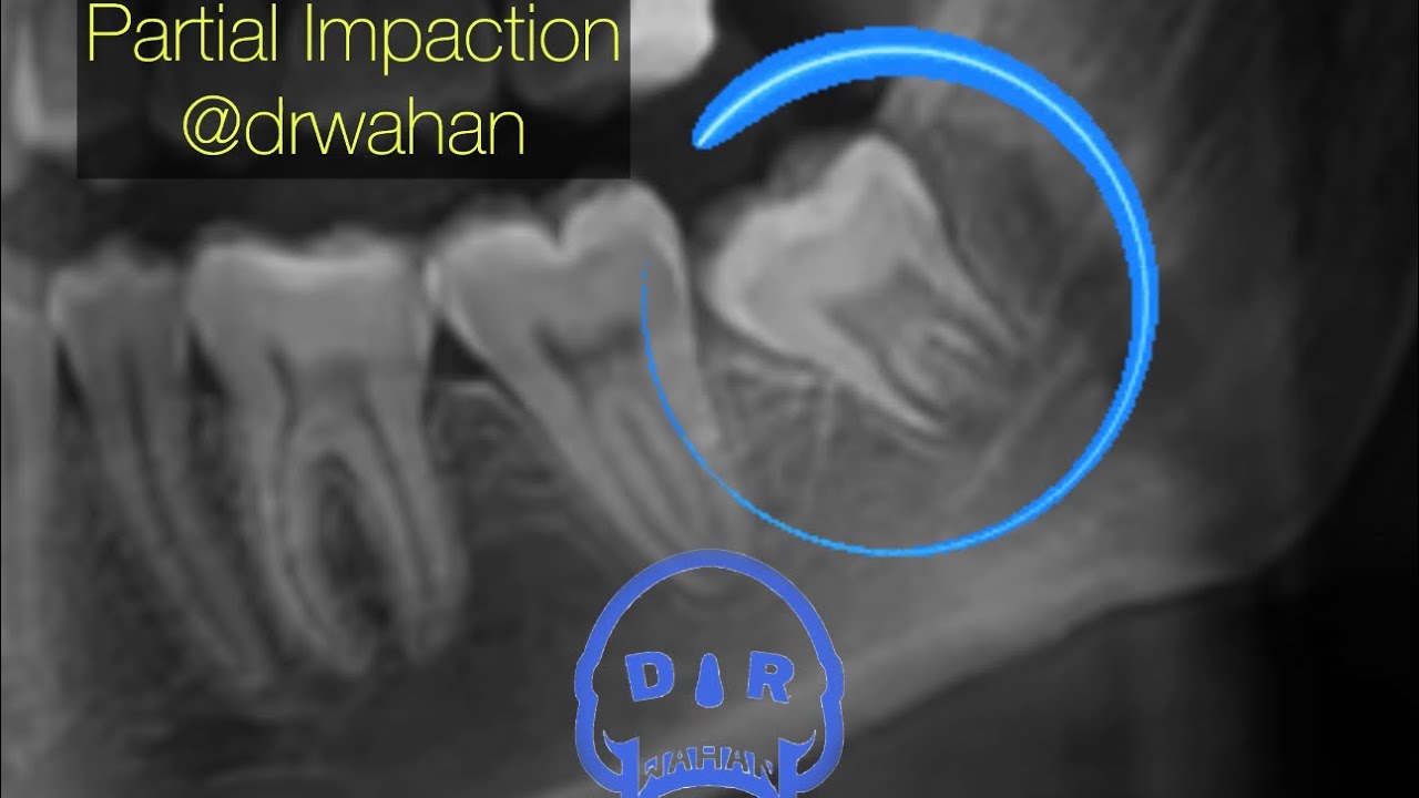 Partial Impaction Wisdom Tooth Extraction @drwahan - YouTube