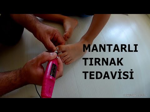 MANTARLI TIRNAK TEDAVİSİ GARANTİLİ