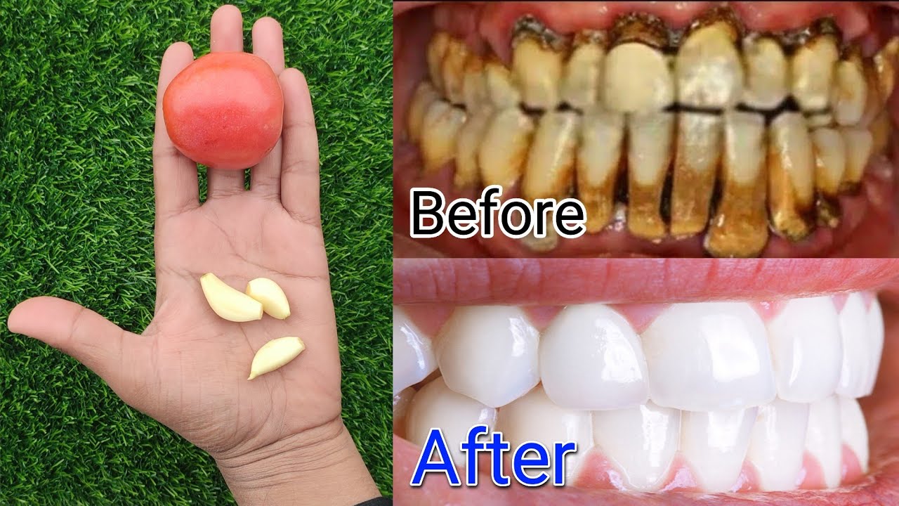 Teeth whitening at home in 3 minutes || How to naturally whiten your ...