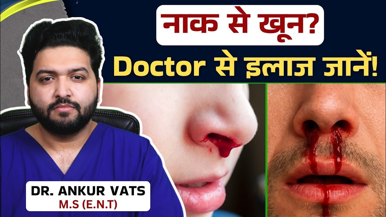 Nosebleed बार-बार क्यूं होता है? Most effective nosebleed treatment ...
