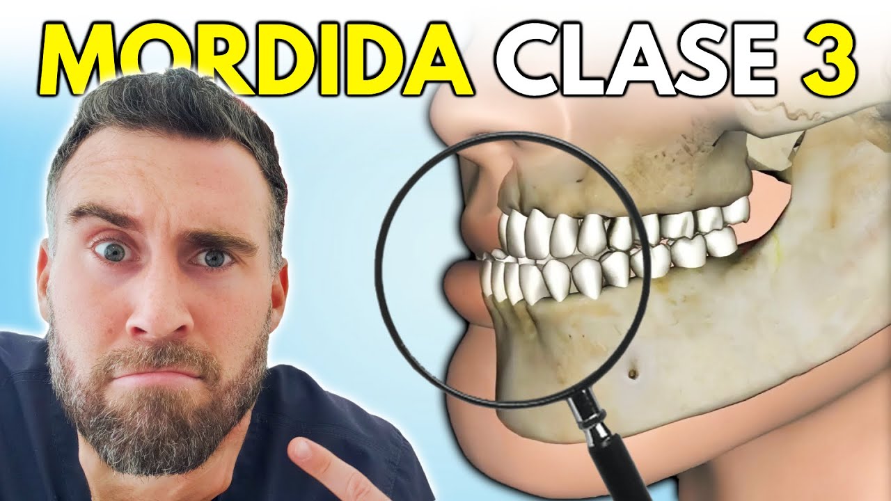 Maloclusión CLASE 3 🚦 TRATAMIENTO de la MANDÍBULA ADELANTADA | MORDIDA ...