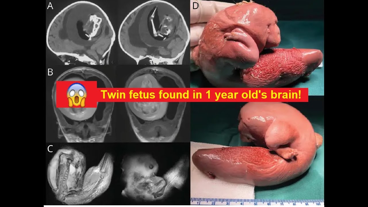Parasitic Unborn Twin Found in 1-Year-Old’s Brain - YouTube