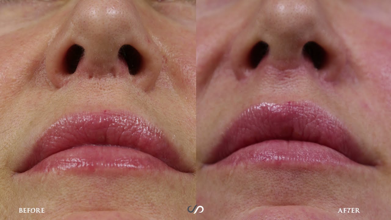 REVISION LIP LIFT | Before and After Video | Dr. David Stoker - YouTube