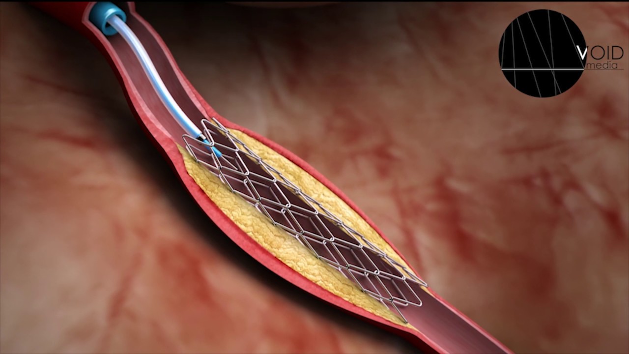 VOID Cleveland Clinic AD PCI Medical Animation - YouTube