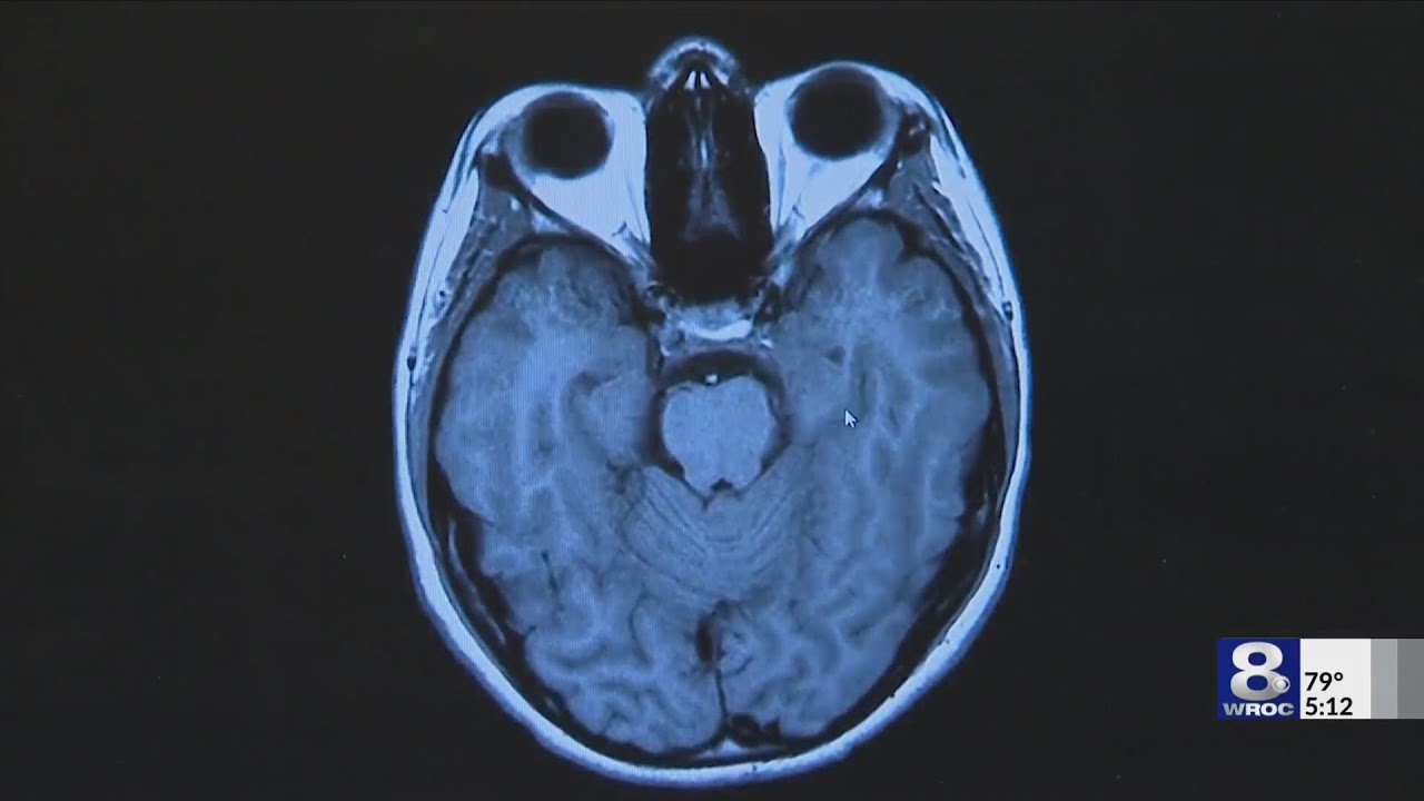 Local Experts: Treatment for concussions is evolving for both long and ...