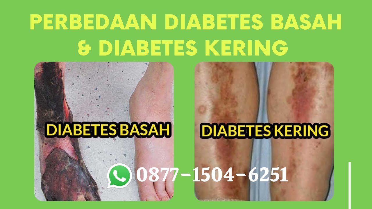 Jangan Anggap Remeh Penyakit Diabetes Kering & Diabetes Basah ! INI ...